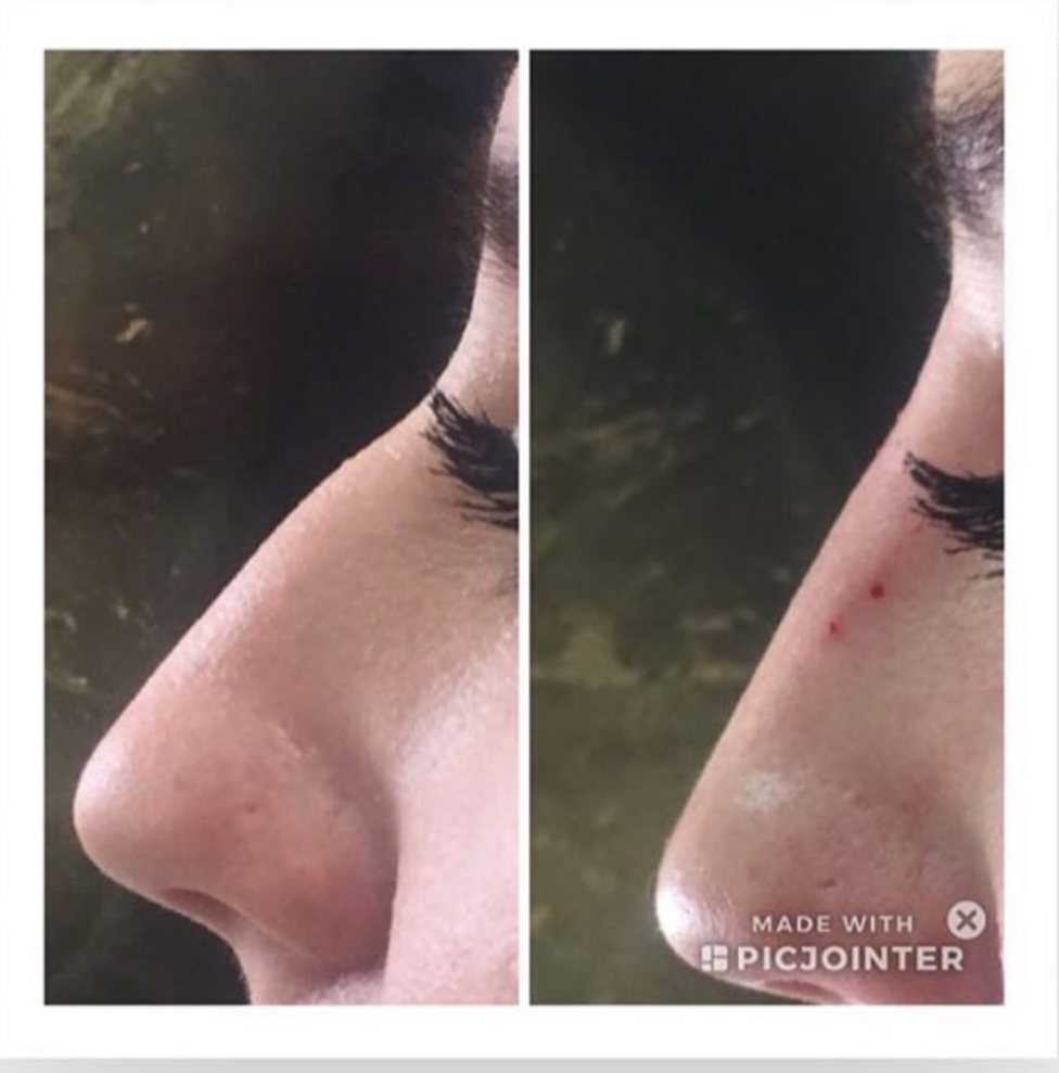 Nekirurška rinoplastika