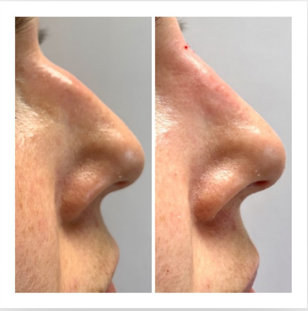 Nekirurška rinoplastika