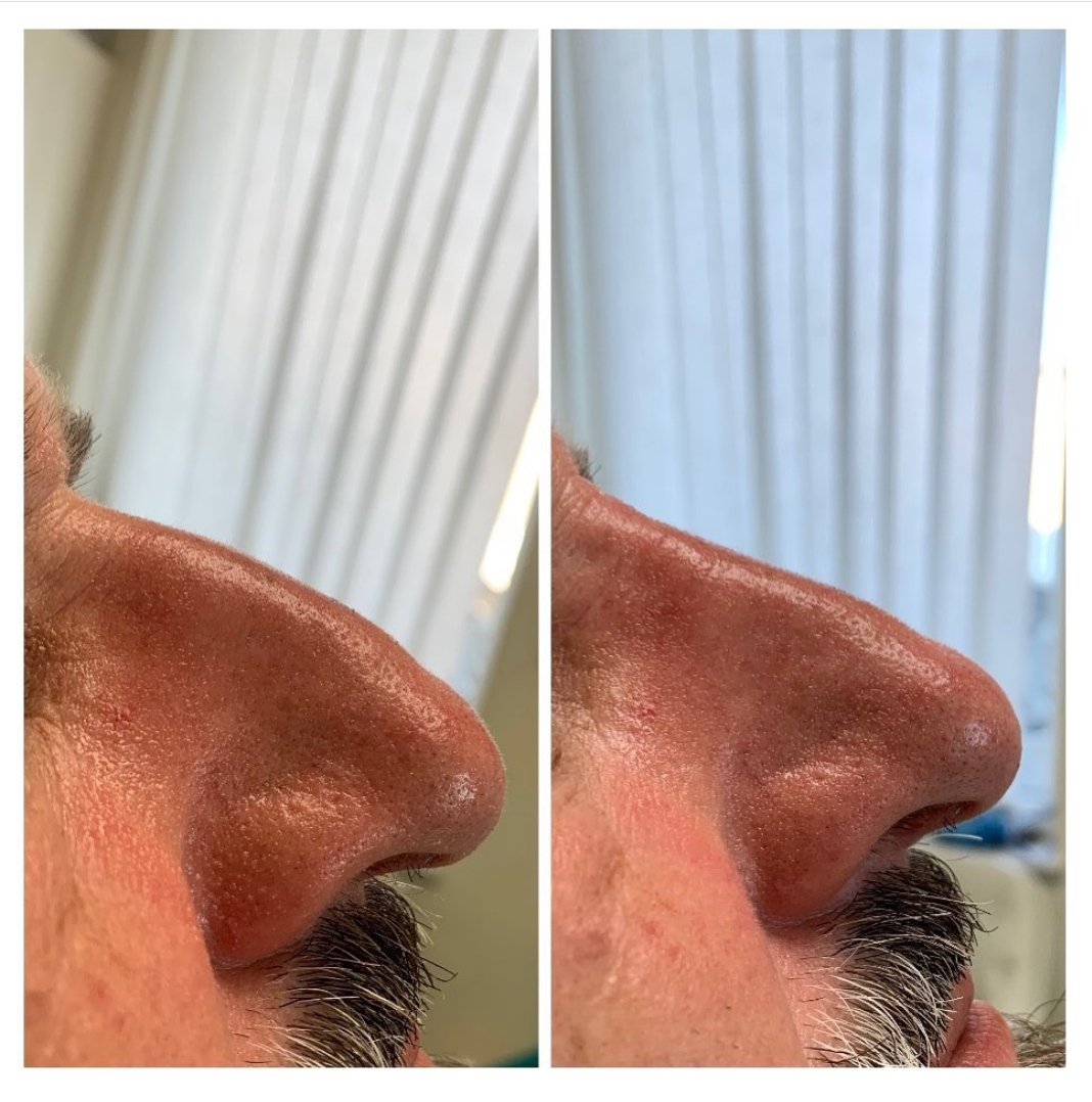 Nekirurška rinoplastika