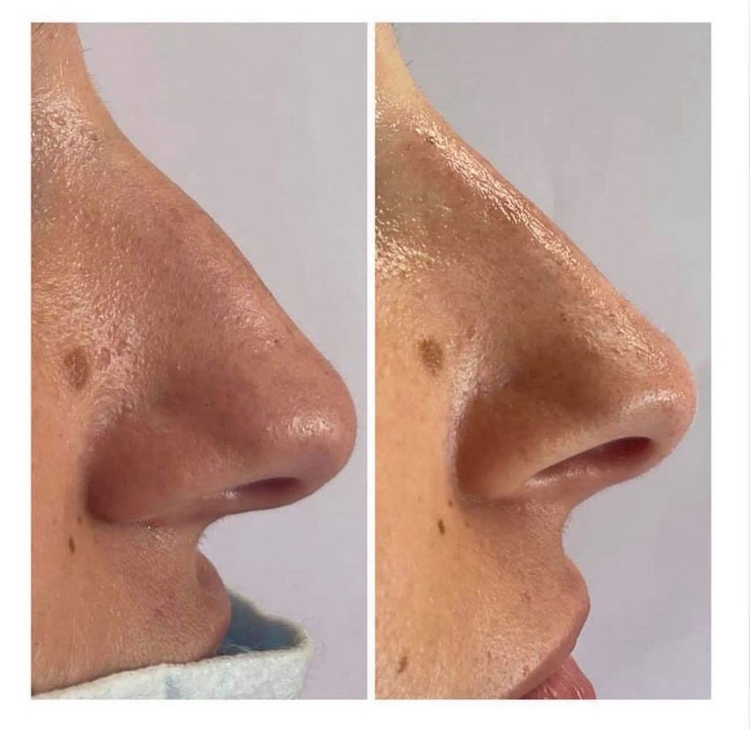 Nekirurška rinoplastika